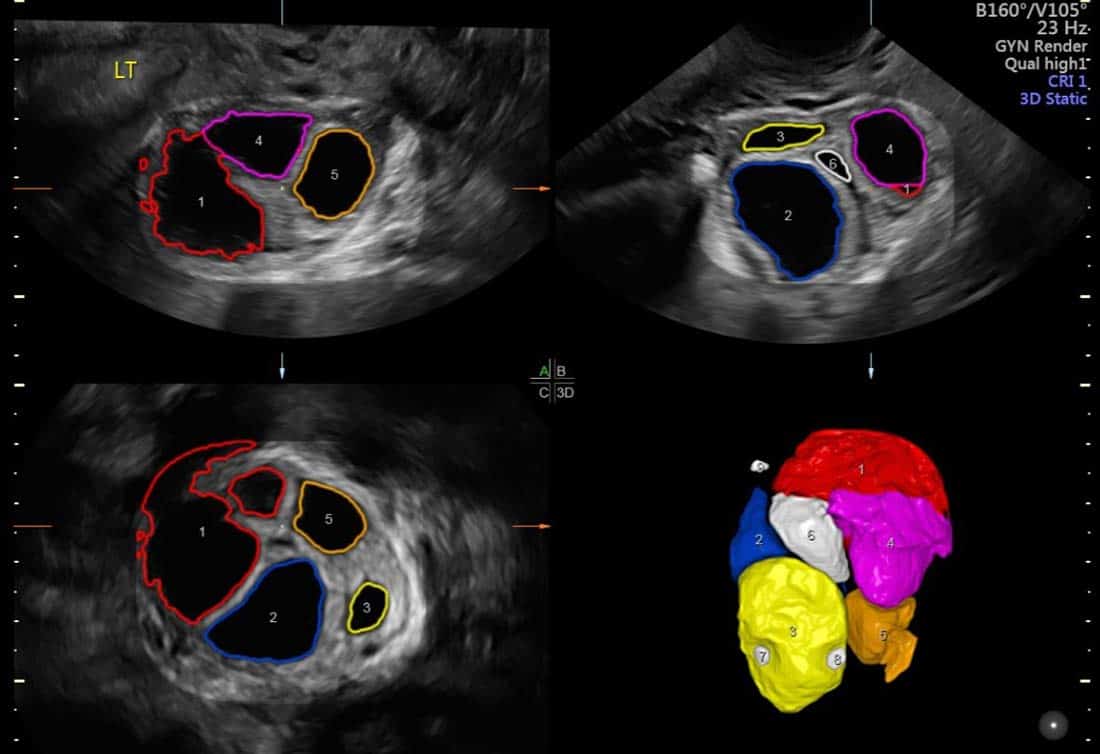 3D Ultrasound For Follicle Monitoring In Art – OIYRHW