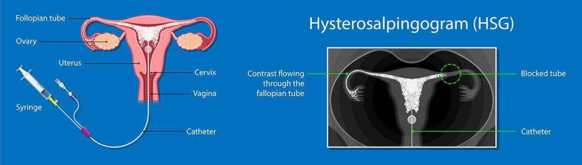 HSG and Fallopian Tube Recanalization - Veritas Fertility & Surgery