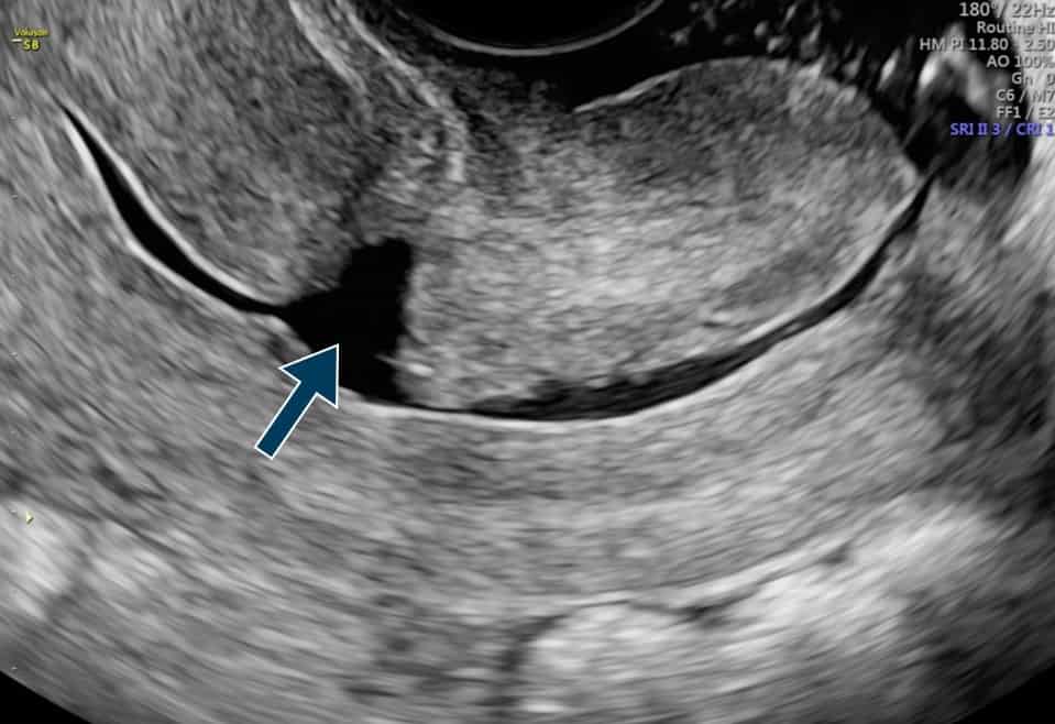 ultrasound-isthmocele-niche - Veritas Fertility & Surgery