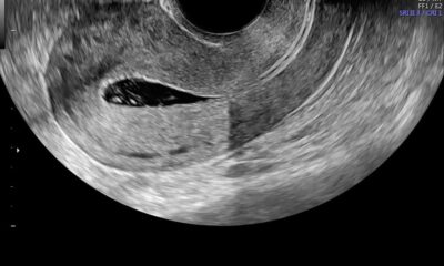 Saline Infusion Sonohysterogram (SIS) | Veritas Fertility